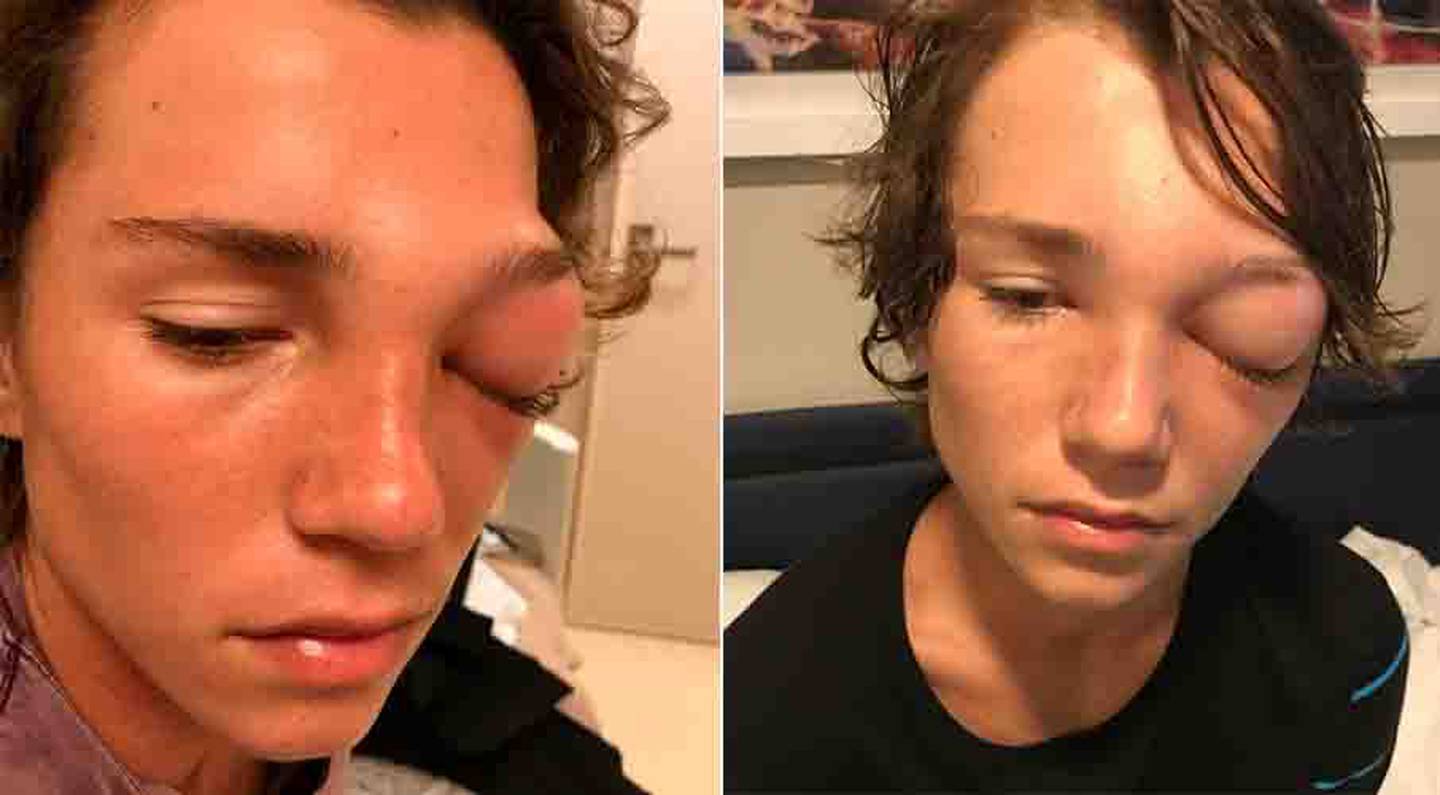 Teen blind in one eye after freak infection | Otago Daily Times Online News