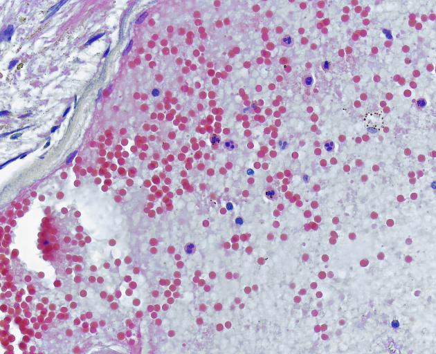 NZ's fourth case of monkeypox confirmed in South Island | Otago Daily ...